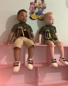 The twin of a dark-skinned baby turned out to be a red-haired albino ...